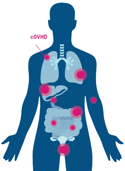 REZUROCK® (belumosudil) website for patients